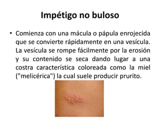Impetigo | PPTX