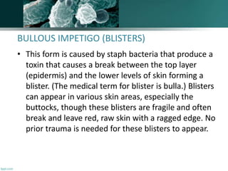 impetigo disease and it's management ppt | PDF