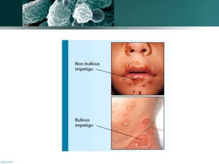impetigo disease and it's management ppt | PPT