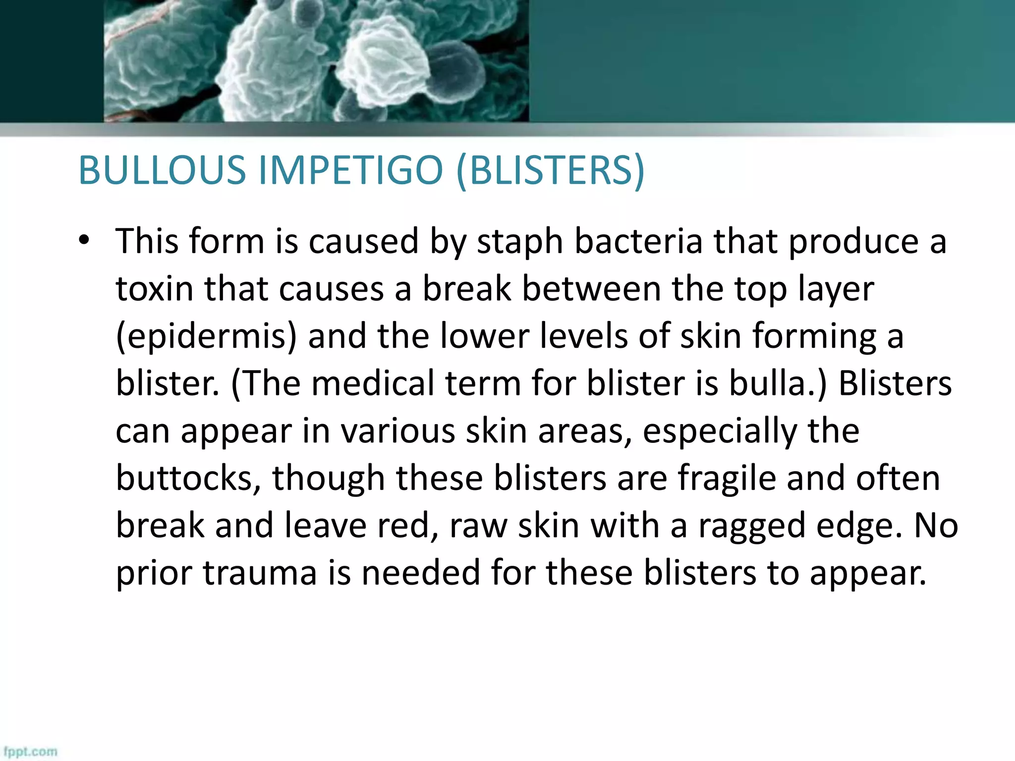 Impetigo | PPTX