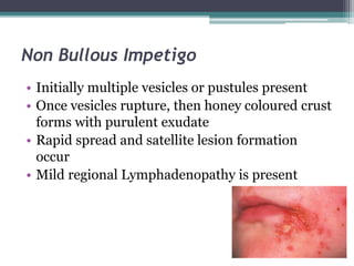 impetigo- complete information including treatment | PPT