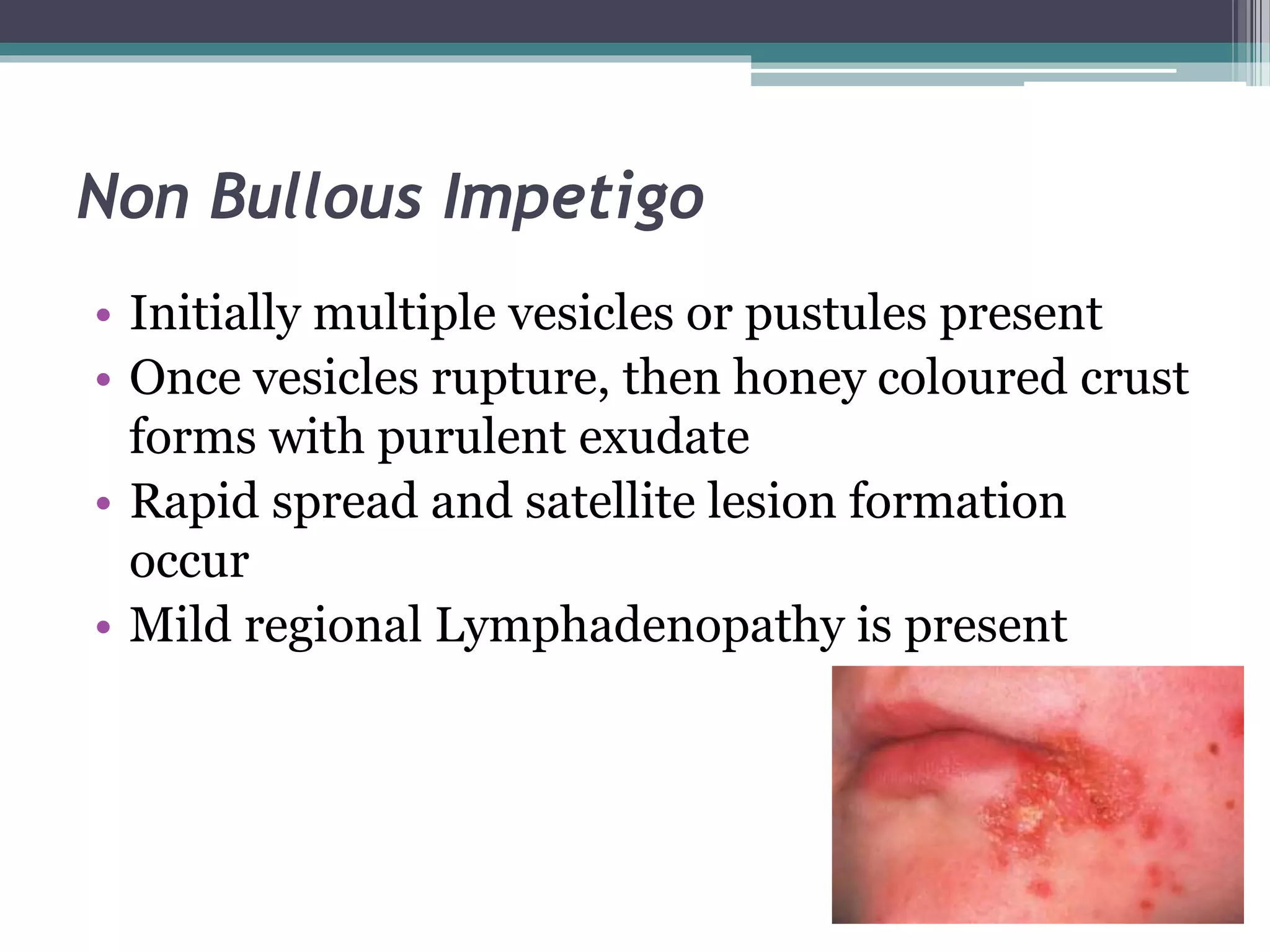 Impetigo | PPTX