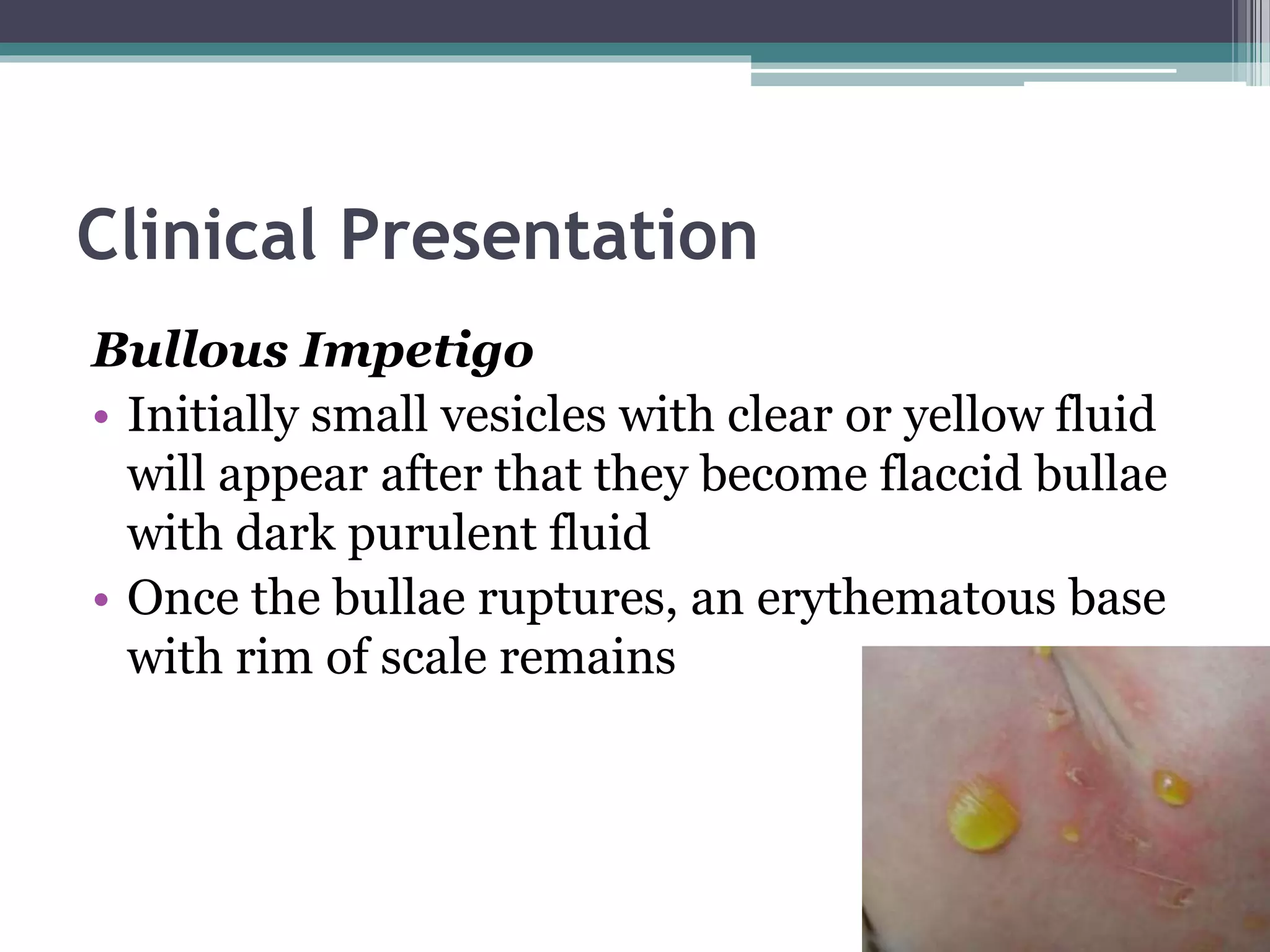 Impetigo | PPTX