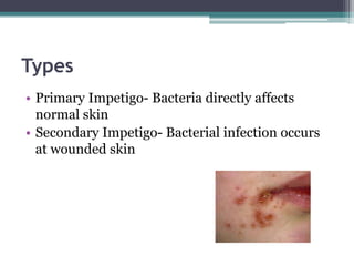 Impetigo | PPTX