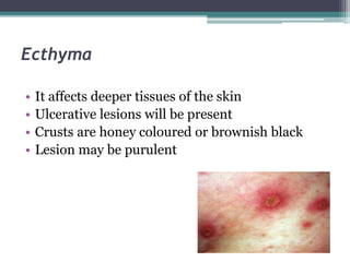 Ecthyma Impetigo