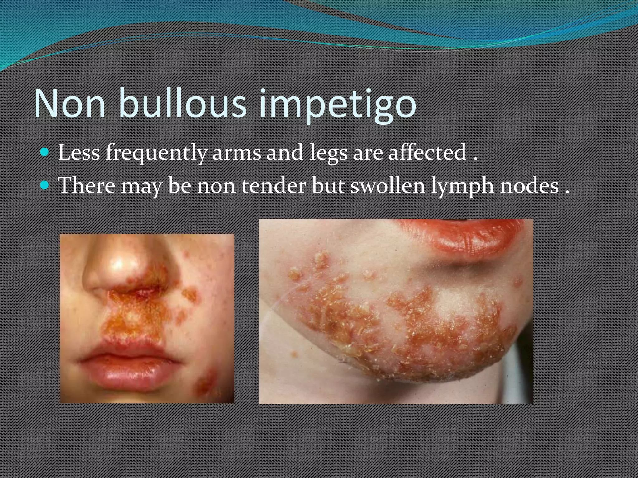 Impetigo | PPTX