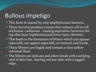 Impetigo | PPTX
