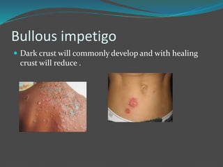 Impetigo | PPTX