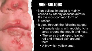 Impetigo | PPTX