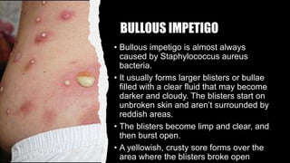 Impetigo | PPTX
