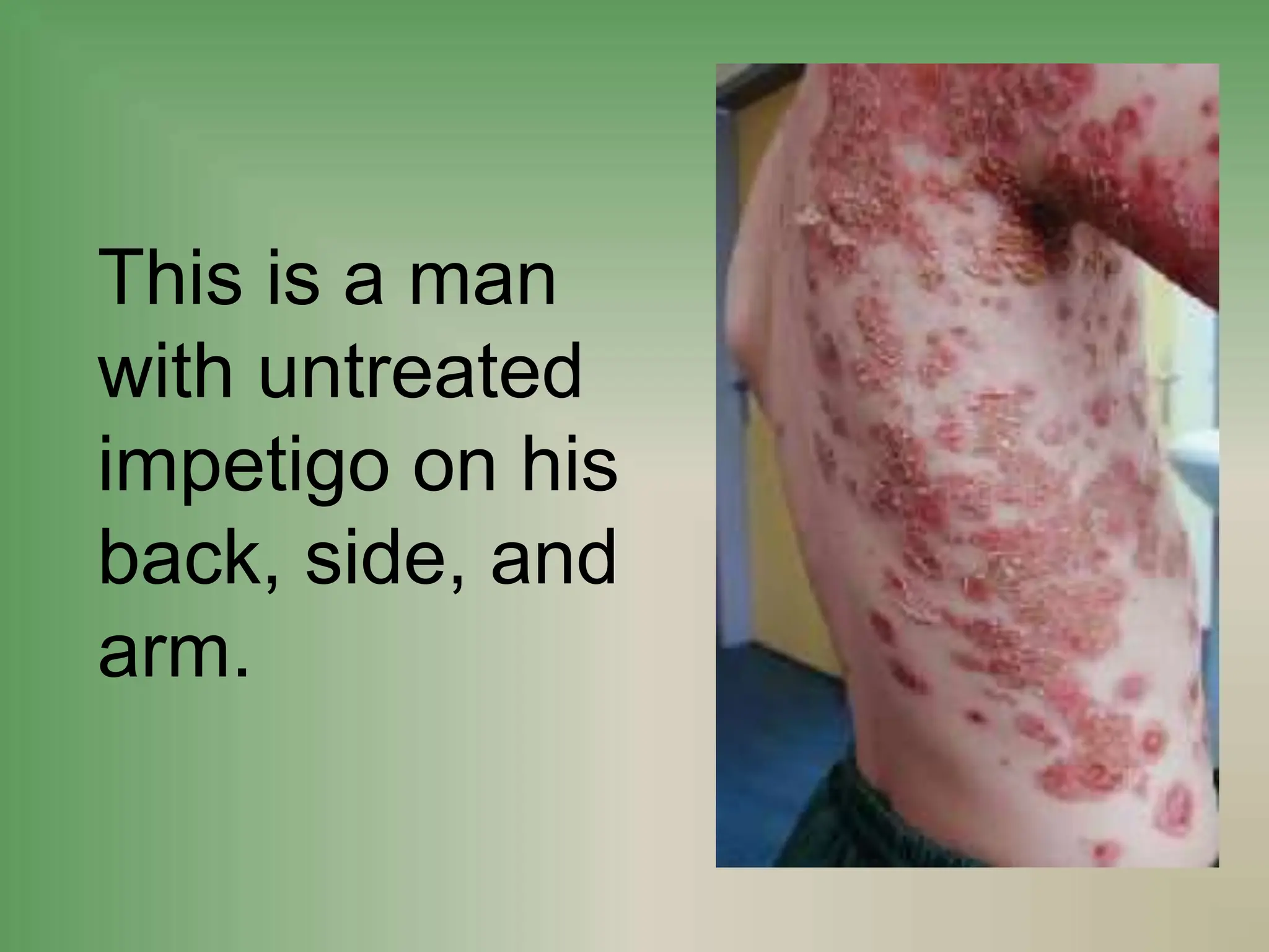Impetigo lecture for undergraduate students | PPTX