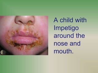 Impetigo lecture for undergraduate students | PPTX