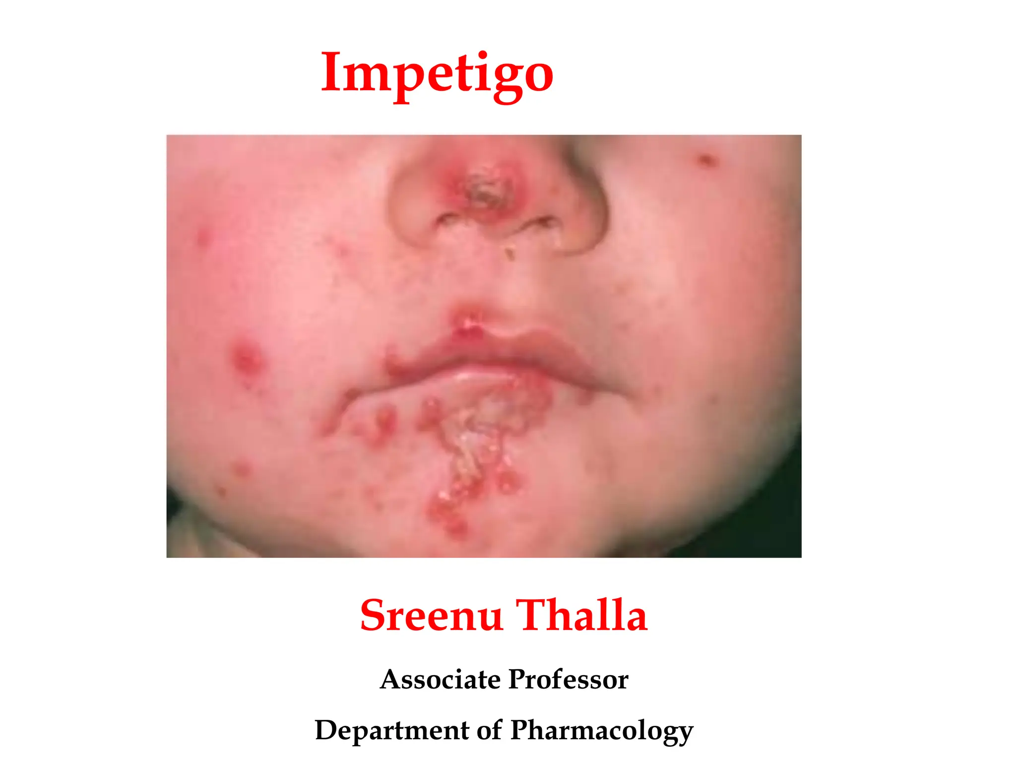 Clinical Pharmacotherapy of Impetigo.pptx