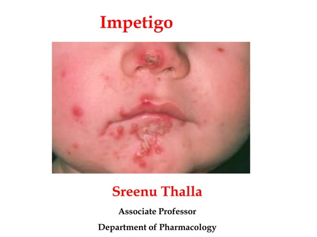Clinical Pharmacotherapy of Impetigo.pptx