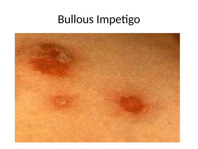 IMPETIGO presentation for nursing student.pptx
