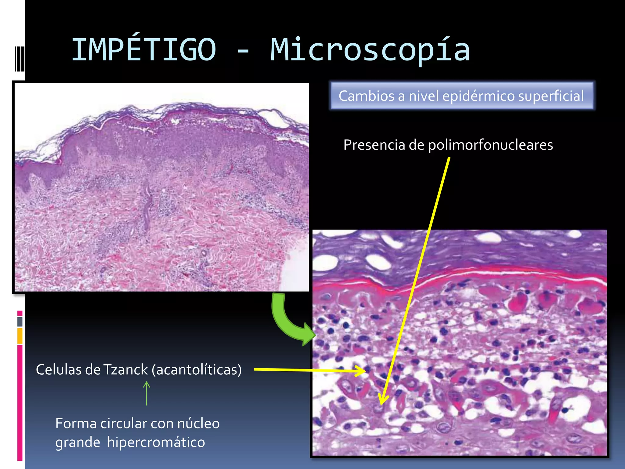 Impetigo Y Erisipela Fisiopatologia Clinica E Histologia Pptx