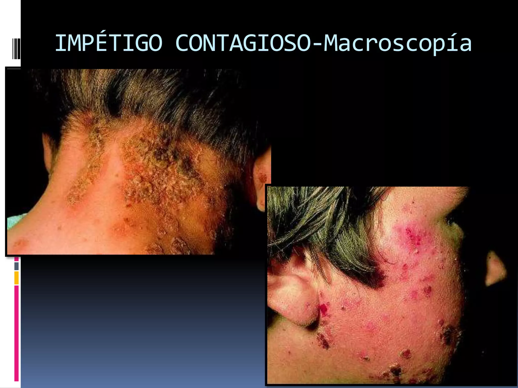 IMPETIGO y ERISIPELA - Fisiopatologia, Clinica e Histologia | PPTX