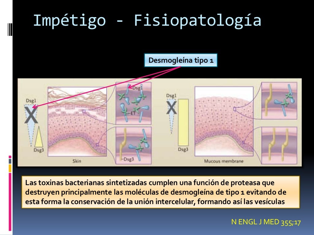 Impetigo Y Erisipela Fisiopatologia Clinica E Histologia