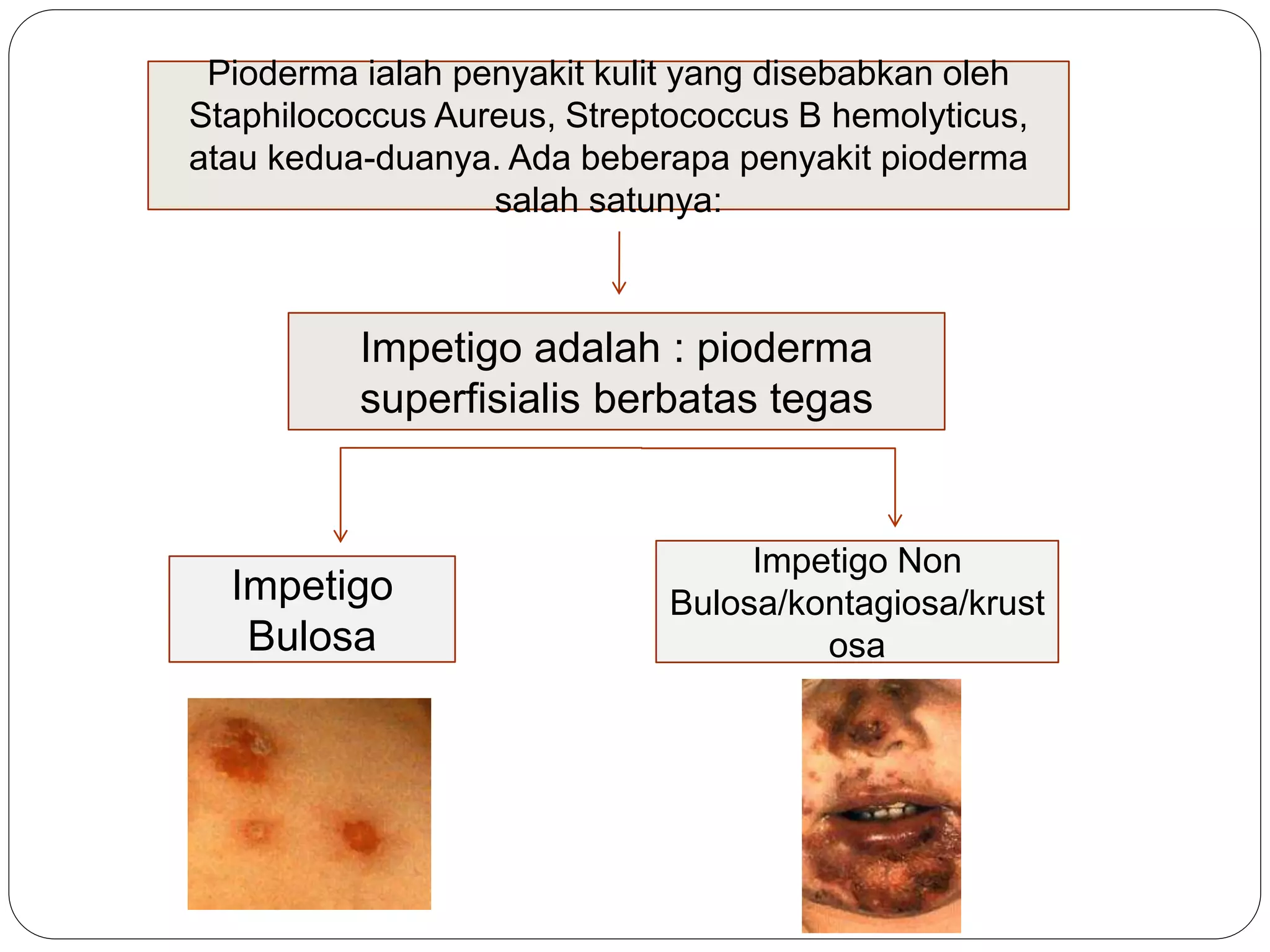 Impetigo Bullosa | PPTX