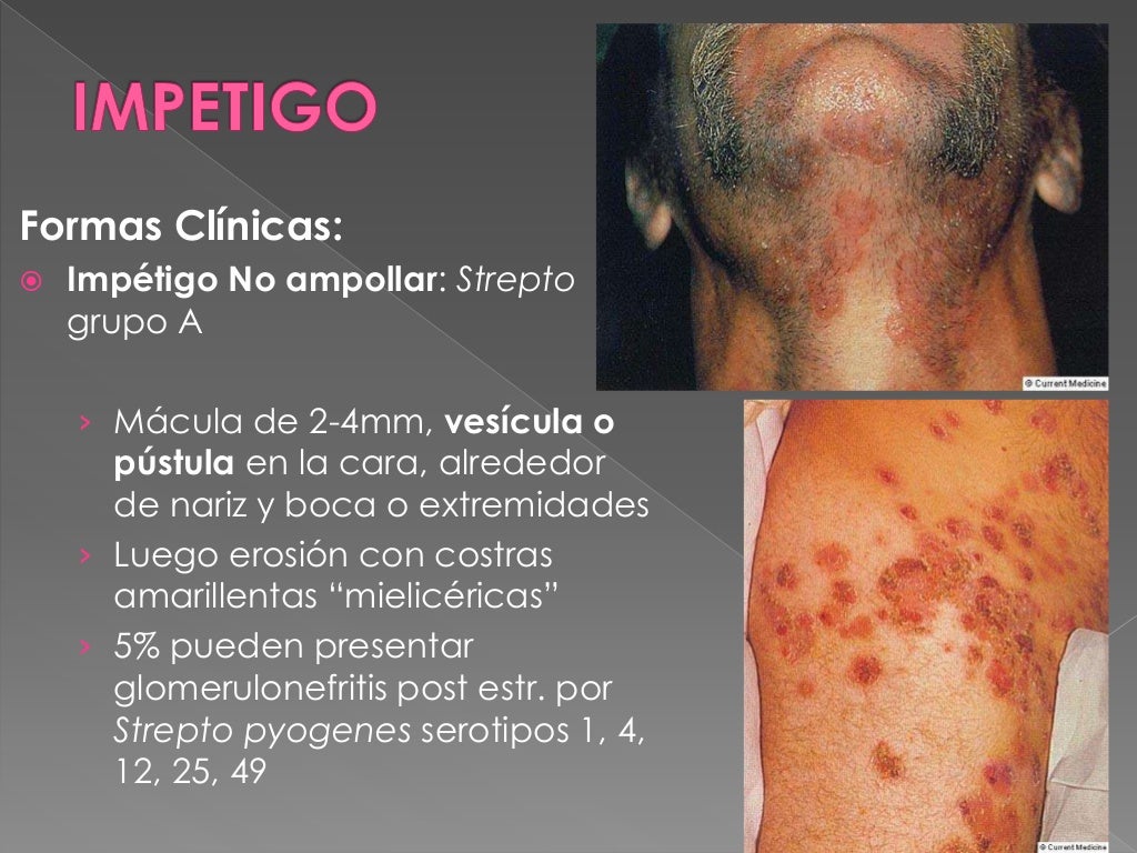Impetigo - dermatologia