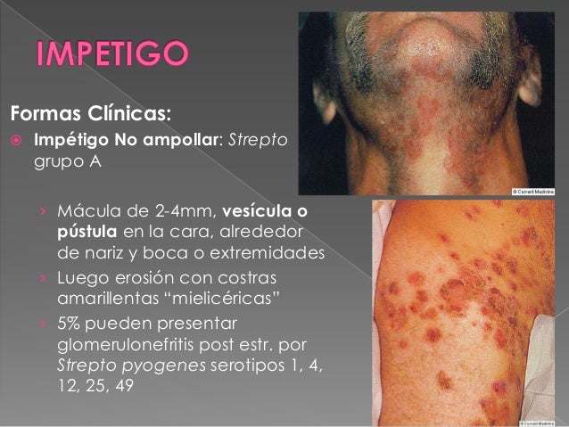 Impetigo - dermatologia