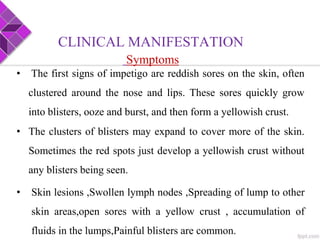 Impetigo | PPTX