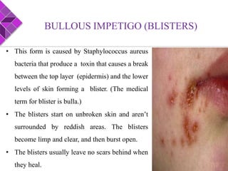Impetigo | PPTX