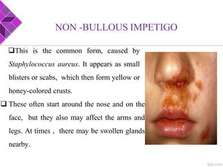 Impetigo | PPTX