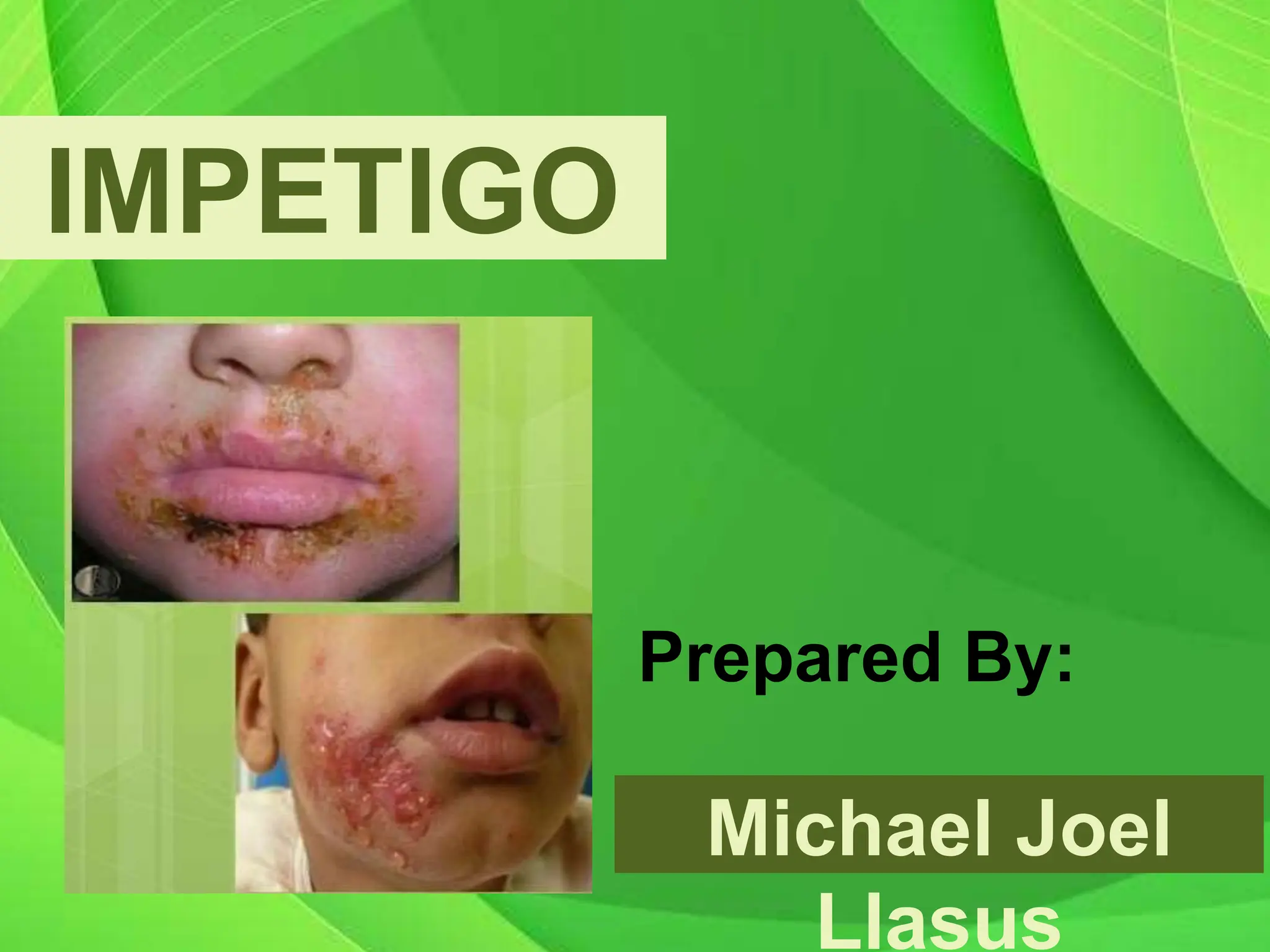 How to treat Empitigo Impetigo childcare caregiving module | PPTX
