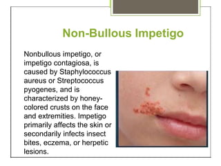 How to treat Empitigo Impetigo childcare caregiving module | PPTX