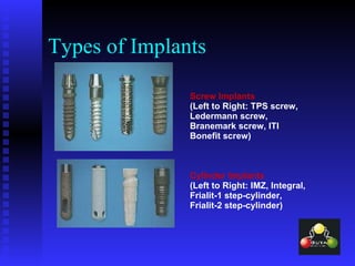 implants | PPT