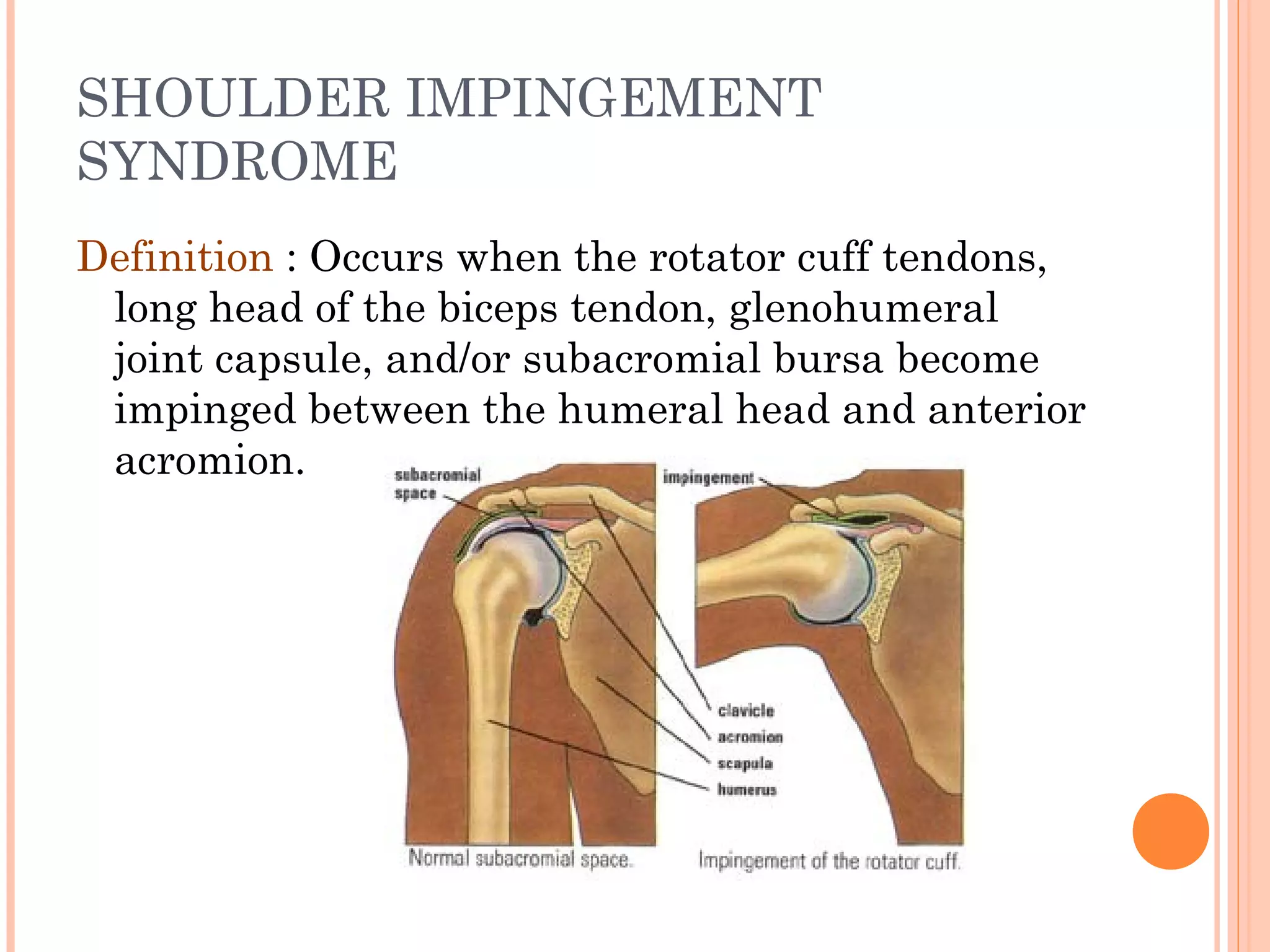 Impingement syndrome rehabilitation | PPT