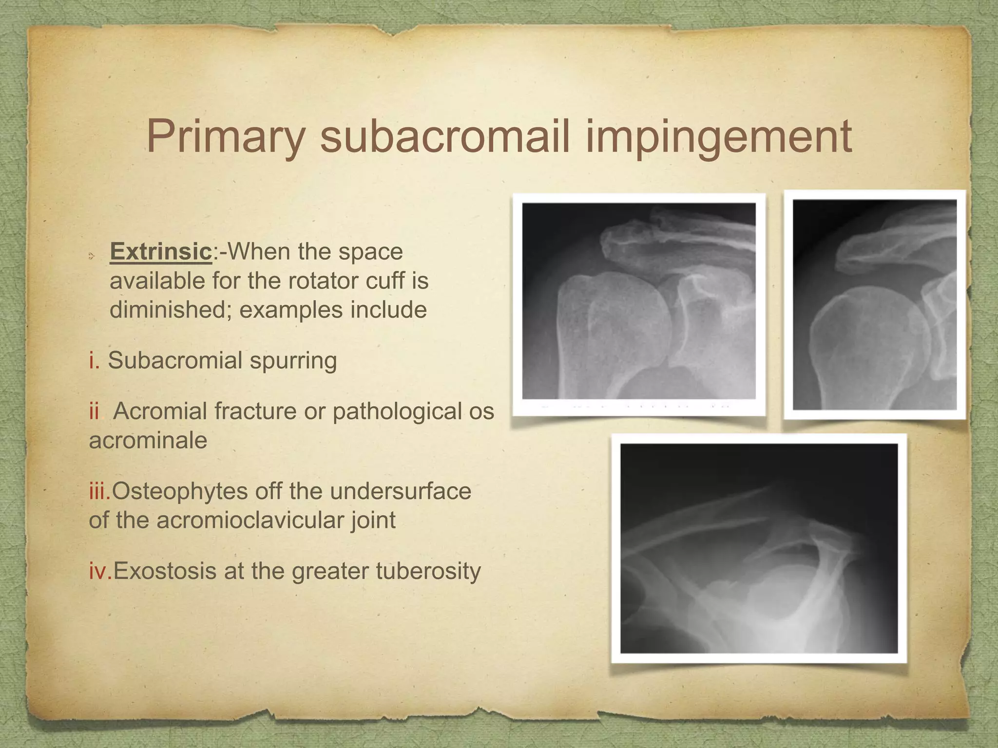 Impingement syndrome | PPTX