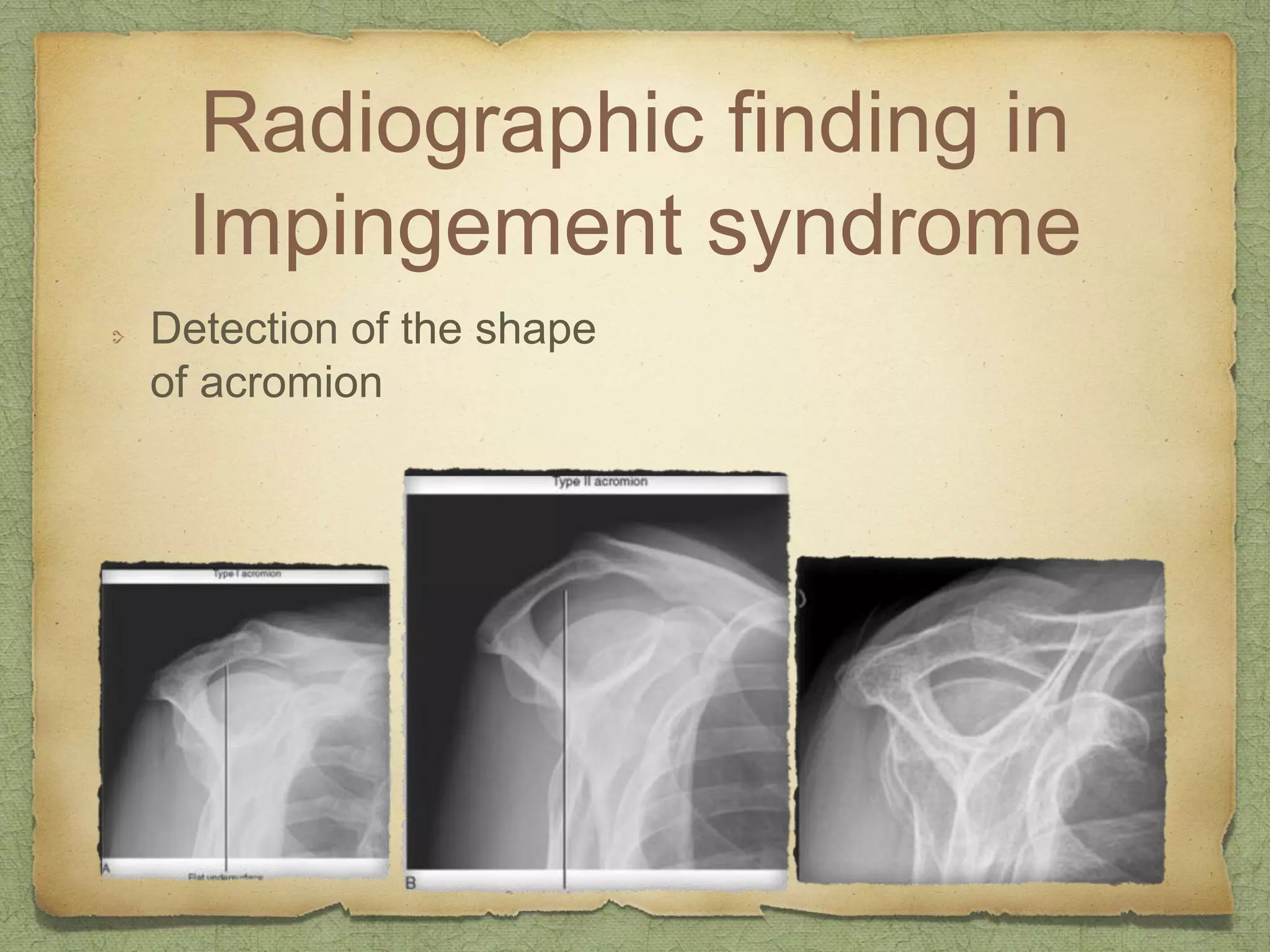 Impingement syndrome | PPTX