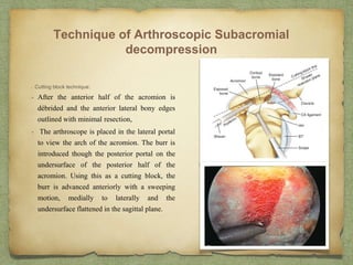 Impingement syndrome | PPTX