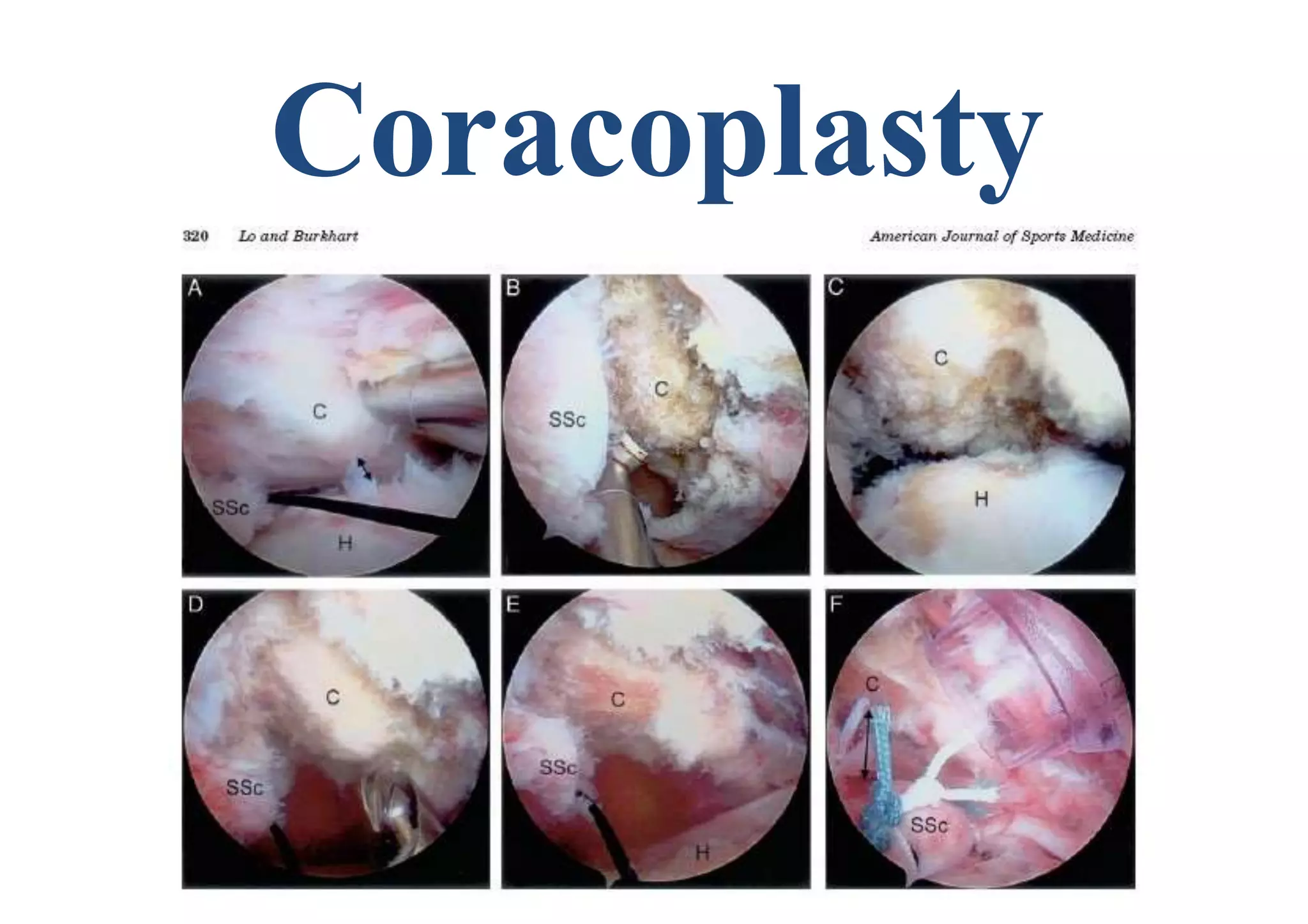 IMPINGMENT SYNDROME & ROTATOR CUFF TEAR.pptx