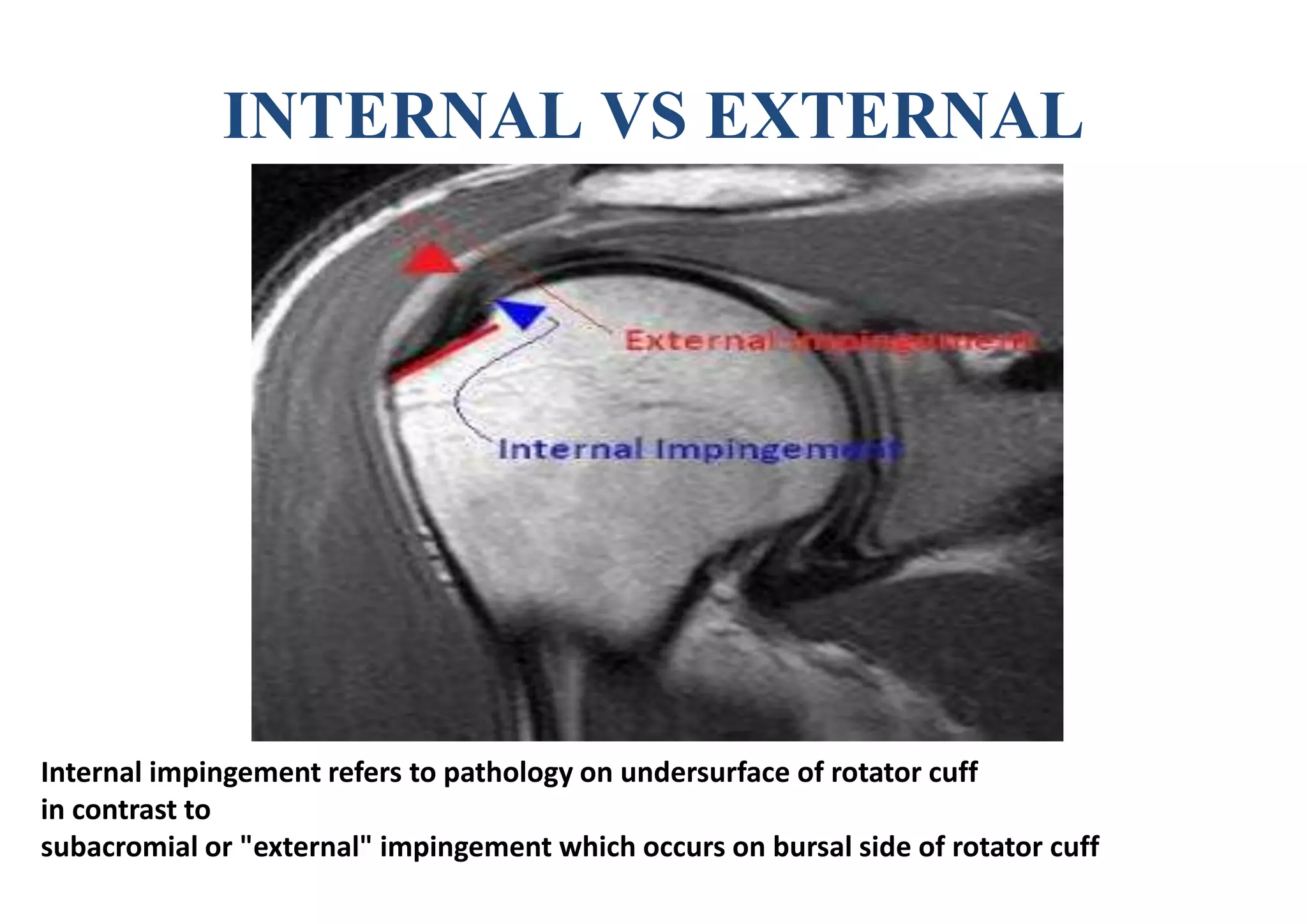 IMPINGMENT SYNDROME & ROTATOR CUFF TEAR.pptx