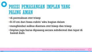 Implan di Indonesia - pemasangan efek samping komplikasi Mei 2024.pdf
