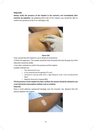 Nexplanon Needle Size