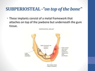 Implant | PPTX