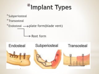 Implant | PPTX