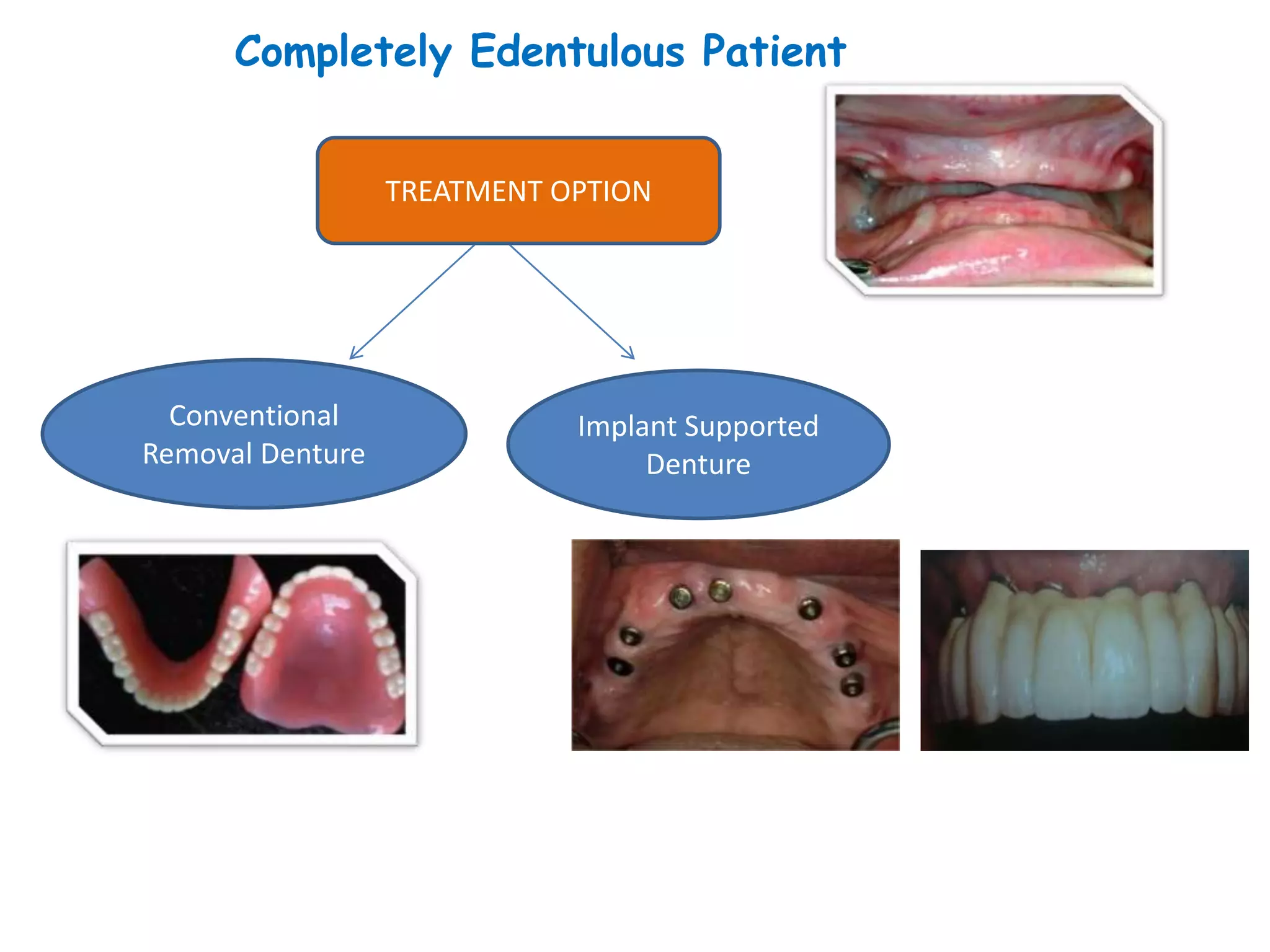 Complete Denture on Implant | PPTX