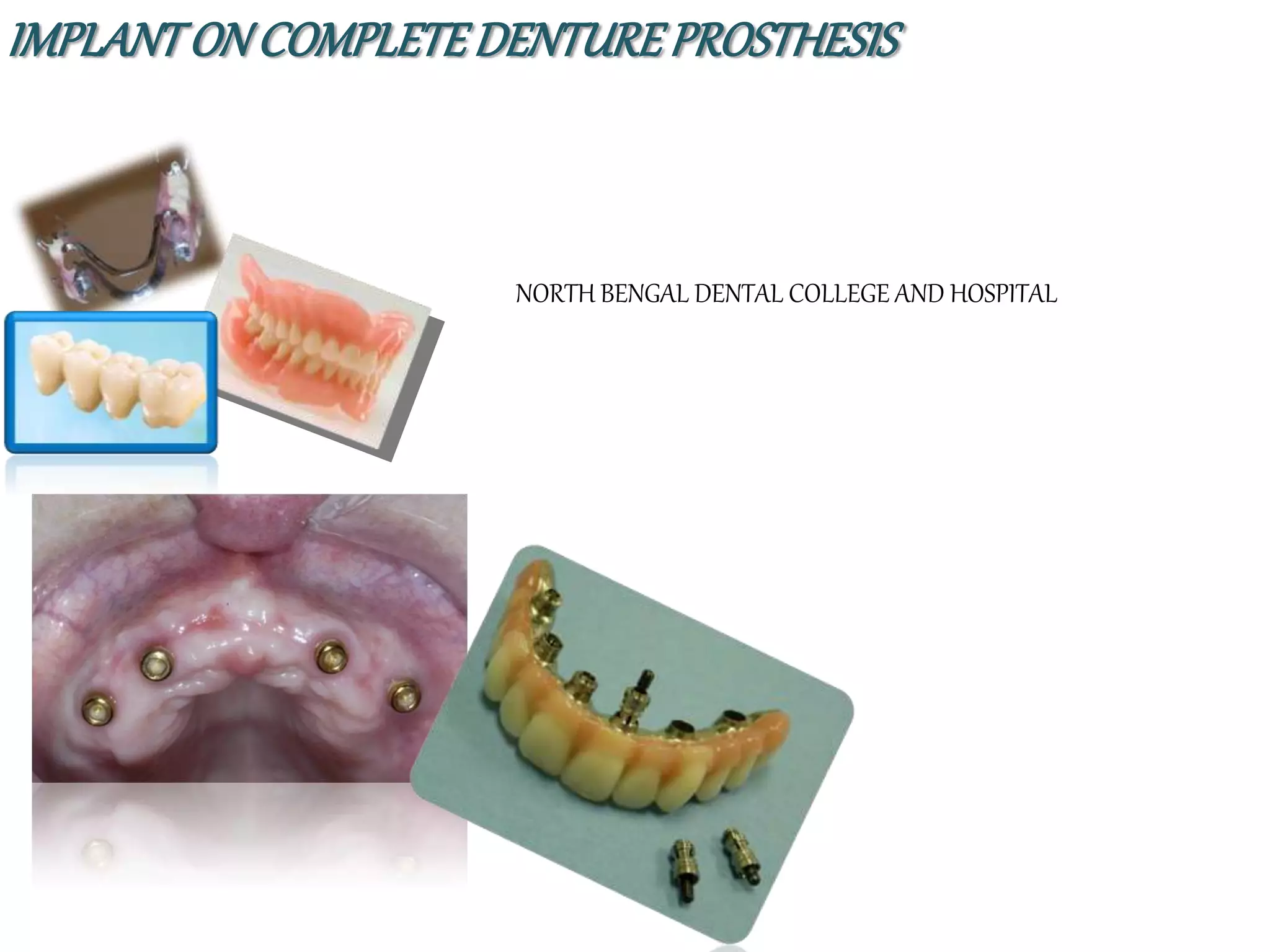 Complete Denture on Implant | PPT