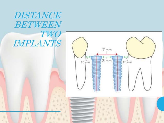 Implant | PPT