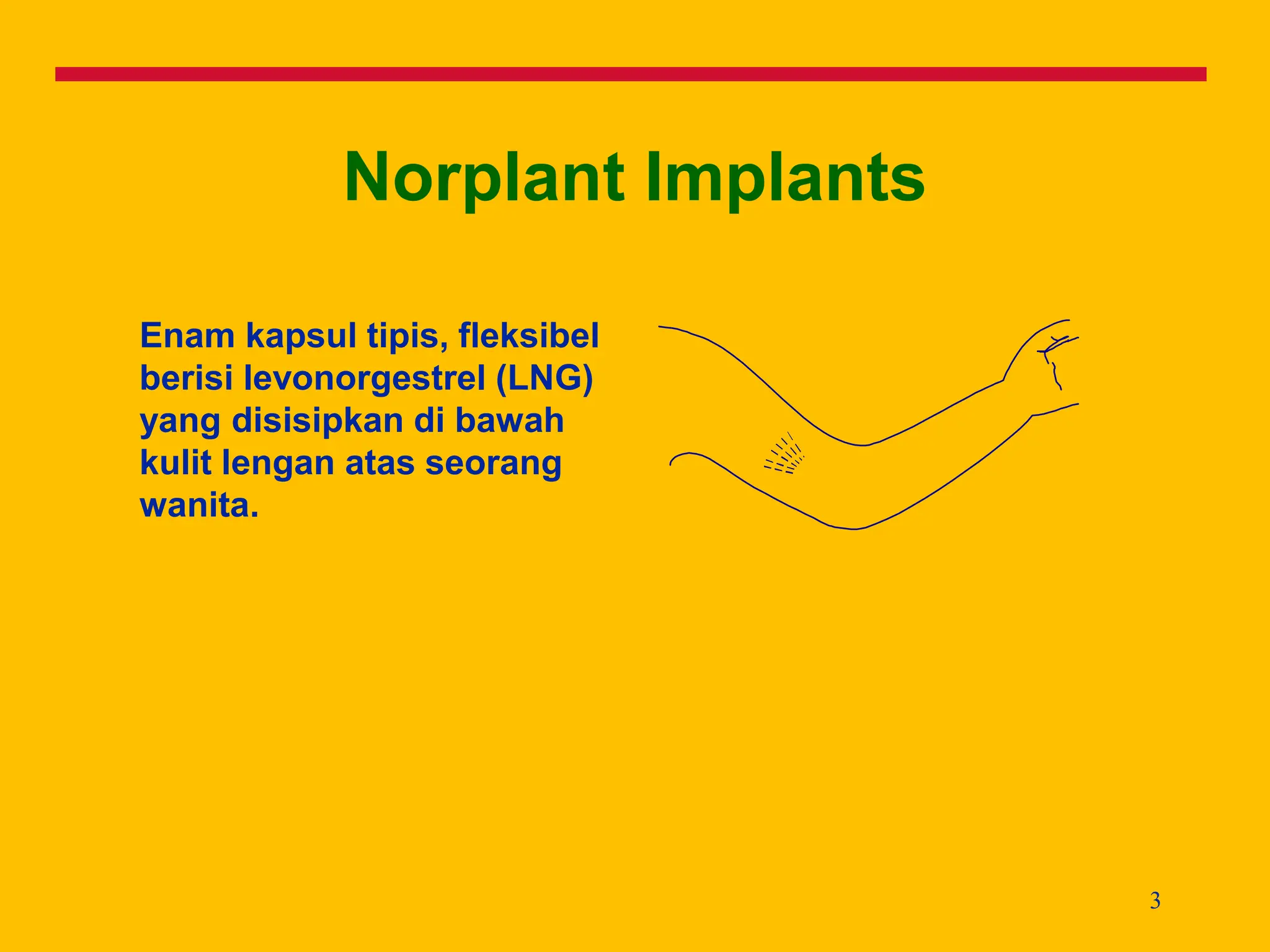 ALAT KONTRASEPSI DAN MACAM-MACAM IMPLANT.ppt