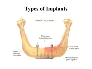types of fixed dental prosthesis include crowns | PDF