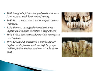 Implant over-denture | PPTX