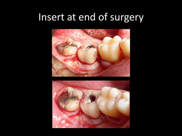 Immediate Implant Placement and Temporization | PPT