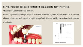 Implantable Drug Delivery Systems – Concepts, Types, and Applications ...