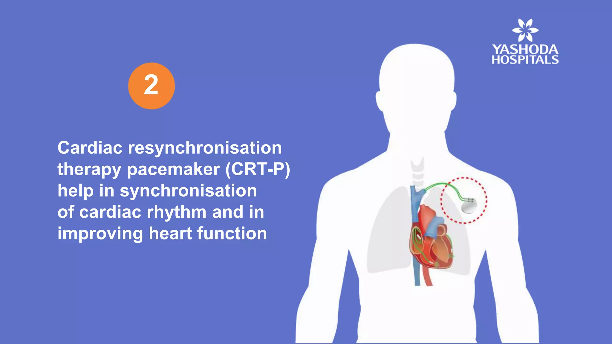 Pacemaker | Implantable Cardiac Devices For Heart Failures | PPT